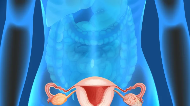 Kenali Endometriosis, Dapat Menyebabkan Nyeri Hebat dan Gangguan ...