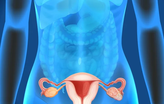 Kenali Endometriosis, Dapat Menyebabkan Nyeri Hebat dan Gangguan ...